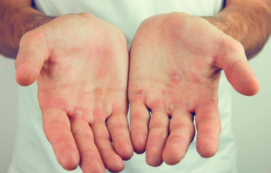 Por qué salen callos en las manos - Diario Libre