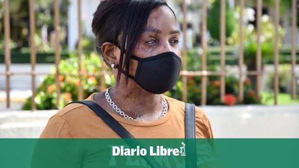 Víctimas de ácido del diablo se manifiestan frente al Congreso Nacional ...
